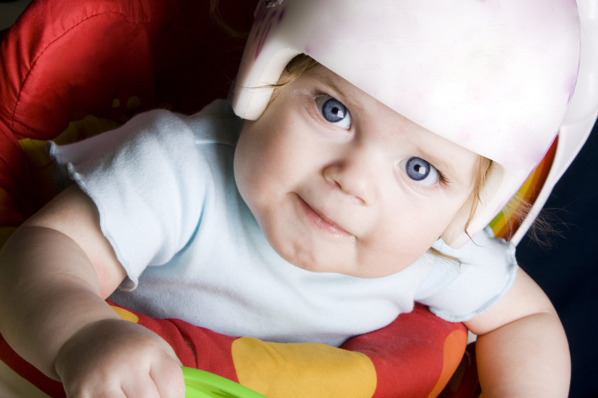 Plagiocephly/Helmet Therapy (Positional) | All Alaska Oral Craniofacial ...